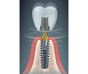 [HOT PRODUCT] 위드웰임플란트 'EZ Crown'